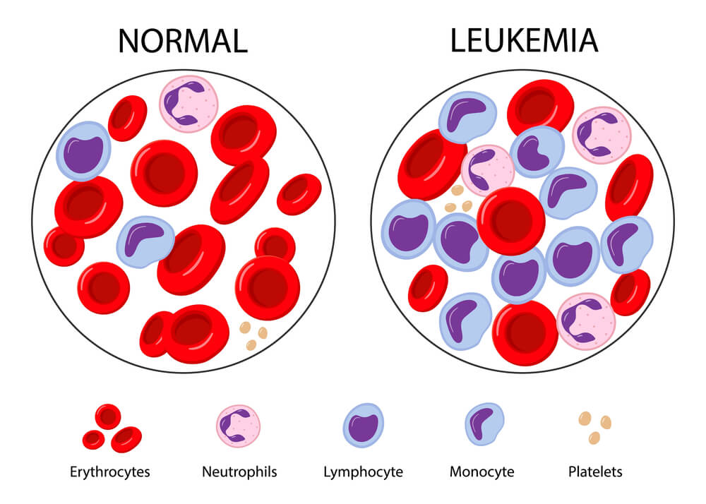 What Are The Causes Of Leukemia?